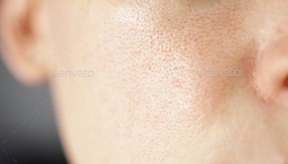 Skin texture, unhealthy with with enlarged pores and rosacea, red ...