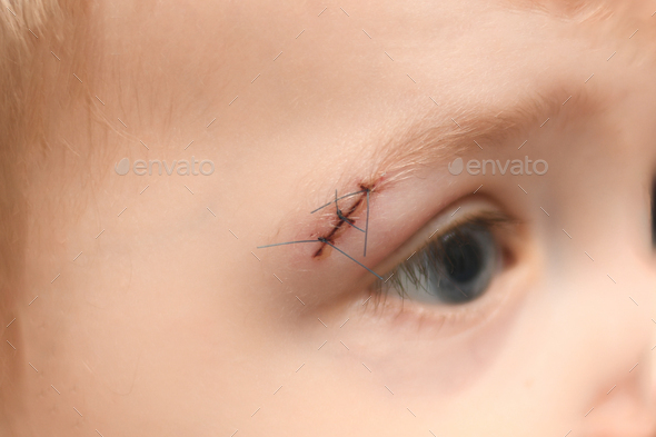 Wound on the eyebrow of a kid after a bruise Stock Photo by o1559kip