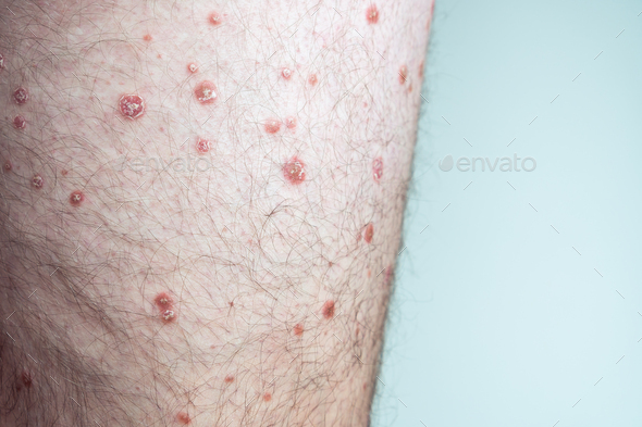 Closeup of red inflamed flaky hairy scaly skin of leg of unrecognizable ...