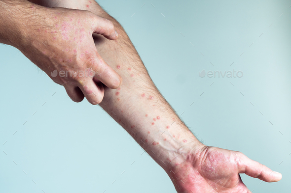 Unrecognizable man suffering from psoriasis scratching thick clusters ...