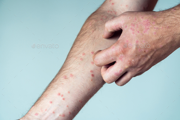 Cropped photo of man suffering from psoriasis scratching thick scaly ...