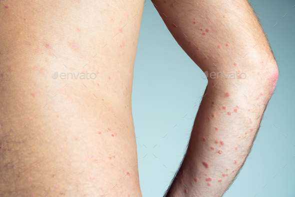 Back view of bare elbow and back of unrecognizable man showing inflamed ...