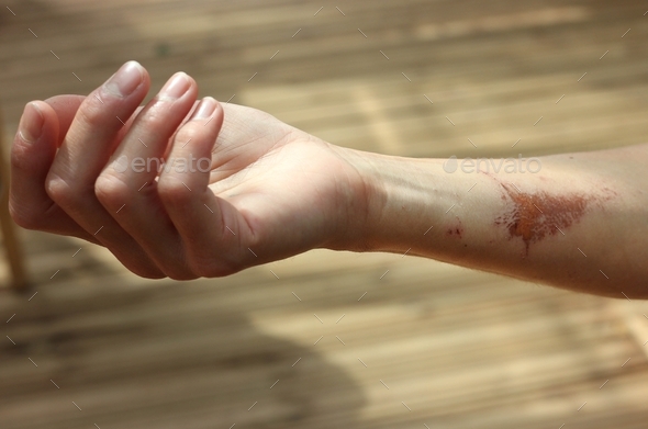 Woman's hand with scar Stock Photo by mirarahneva | PhotoDune