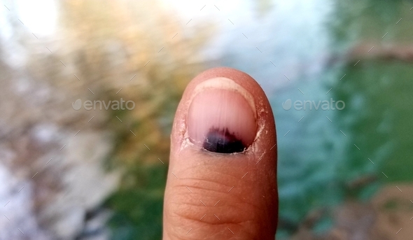 Bruised Fingernail! Smashed! Subungual Hematoma! Stock Photo by AZ-BLT