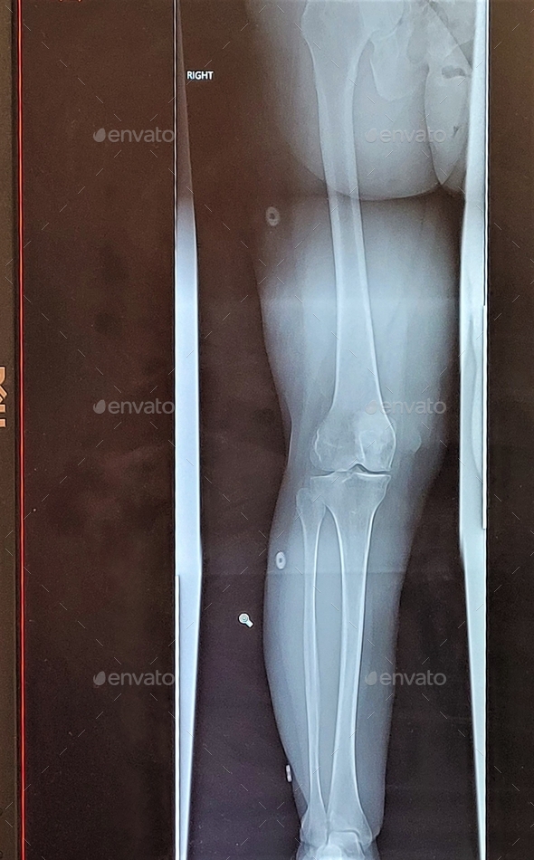 Healthcare and Medicine! Full Human Leg Xray! Stock Photo by AZ-BLT