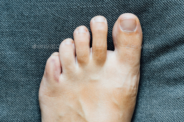 Foot little finger injury. Little toe pain and bruise after home ...