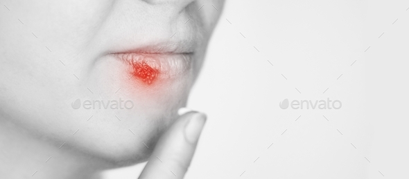 Girl with herpes. Sick mouth symptom. Lips cold Stock Photo by elenavolf