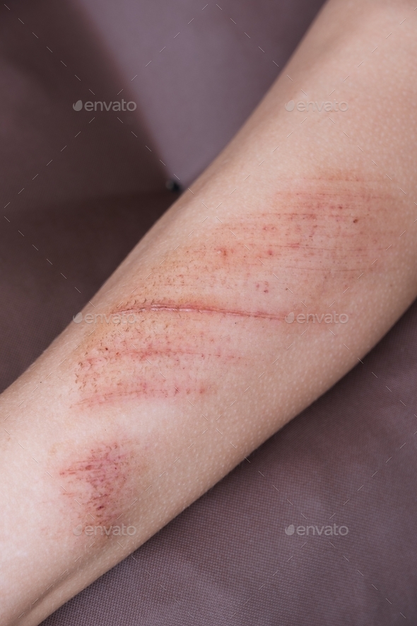 Close up view of wounds, scratches and abrasions on skin of child leg ...