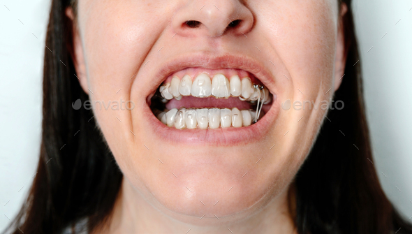 Woman with open mouth using orthodontic treatment with transparent ...