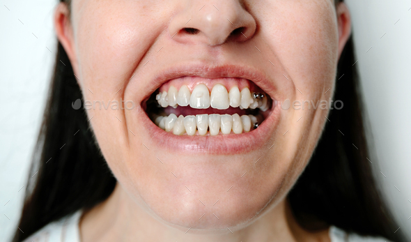 Woman with open mouth showing attachments and dental buttons for ...