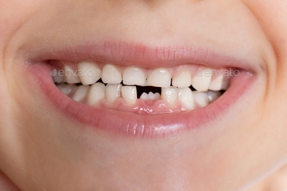 First tooth fell out Stock Photo by o1559kip | PhotoDune
