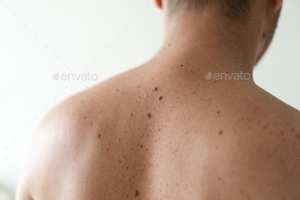 Close up detail of the bare skin on a man back with scattered moles and ...