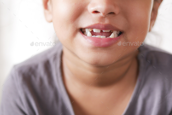 child girl smiling with deformed teeth Stock Photo by towfiqu98 | PhotoDune