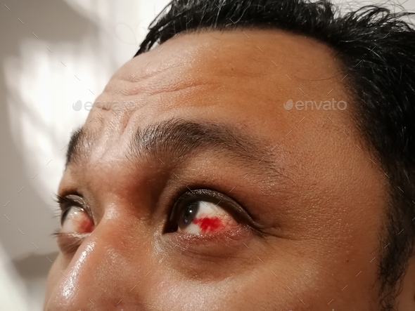 Bloodshot eye. Asian man with burst blood vessel in eye. Very red ...