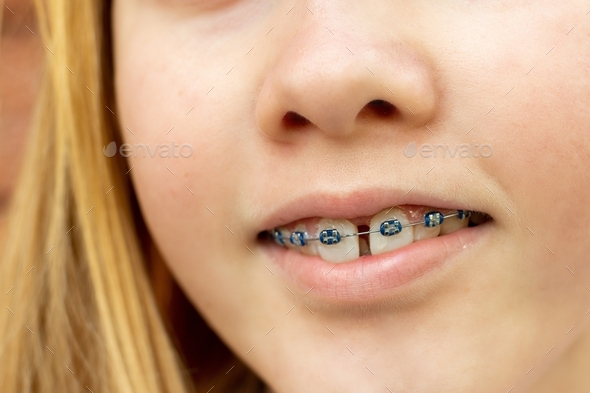 Teenage girl wearing metal braces. Orthodontic dental braces teeth ...