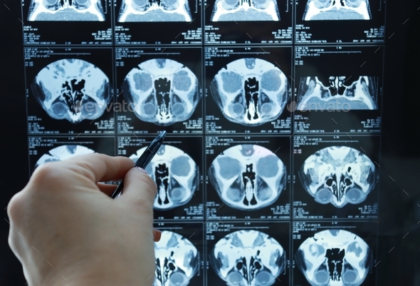 head and eye sockets tomography, x-ray image Stock Photo by NatalieZera