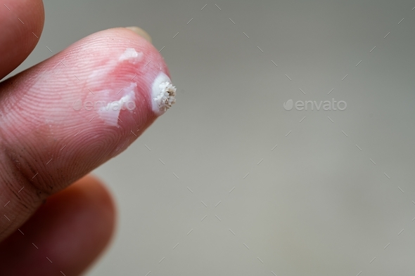 White warts on fingertips, skin disease being treated. Stock Photo by ...