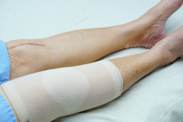 Asian senior woman patient show her scars surgical total knee joint ...