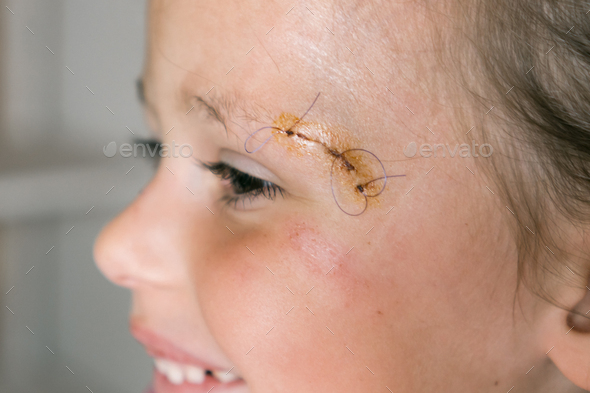 Closeup smiling patient kid girl face with stitches, joint on scratch ...