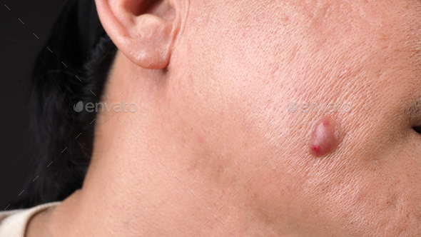 Big Acne Cyst Abscess or Ulcer Swollen area within face skin tissue ...