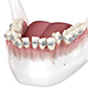 Abnormal Teeth Position and Correction with Metal Braces Tretament ...