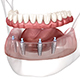 Removable mandibular prosthesis All on 4 system supported by implants ...