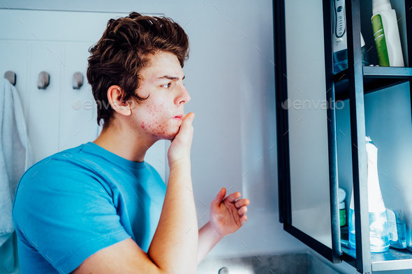 Concentrated caucasian teenage boy with acne problem take care his face ...