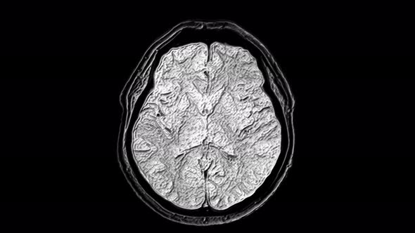 Voluminous MRI Scans of the Brain and Head To Detect Tumors. Diagnostic ...