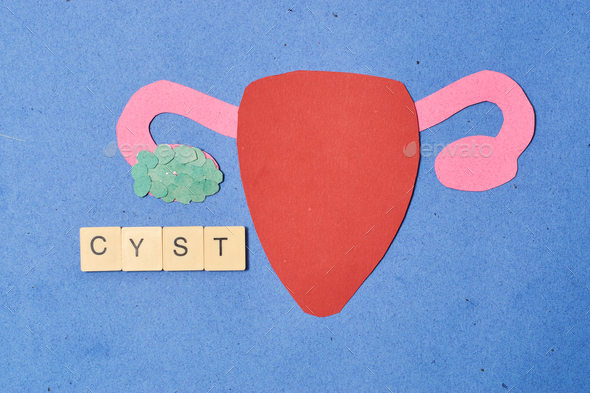 Female uterus made of paper with cyst. Concept Ovarian cyst. Stock ...