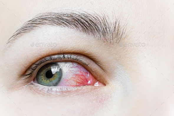 Close up of a severe bloodshot red eye. Viral Blepharitis ...