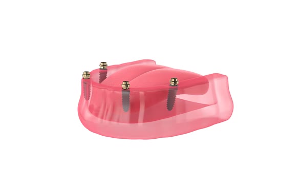 Bar retained removable overdenture installation supported by implants ...