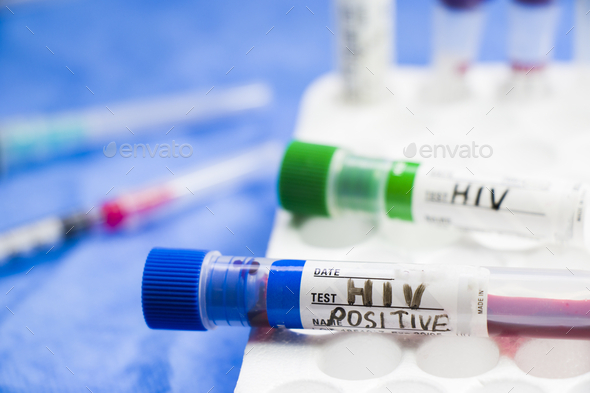 Selective focus of positive HIV blood specimen on test tube in the ...