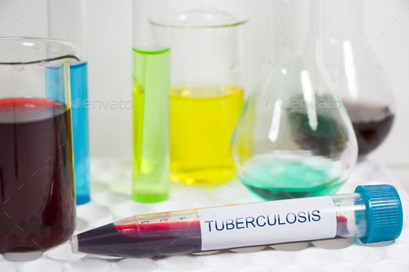 Closeup of a TUBERCULOSIS blood sample test in a tube on the table in a ...