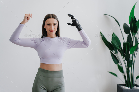 Cute young woman stands at home with bionic hand prosthesis, smiles ...