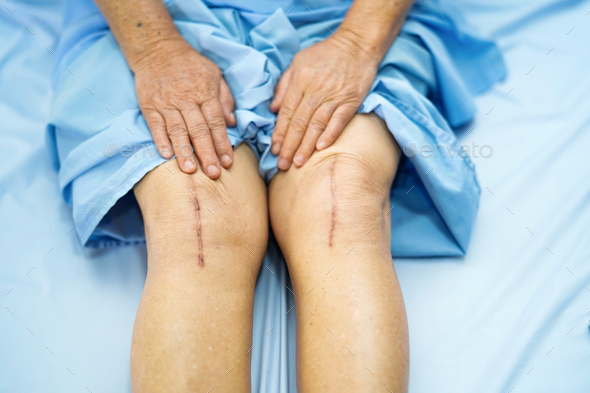 Asian senior woman patient show her scars surgical total knee joint ...