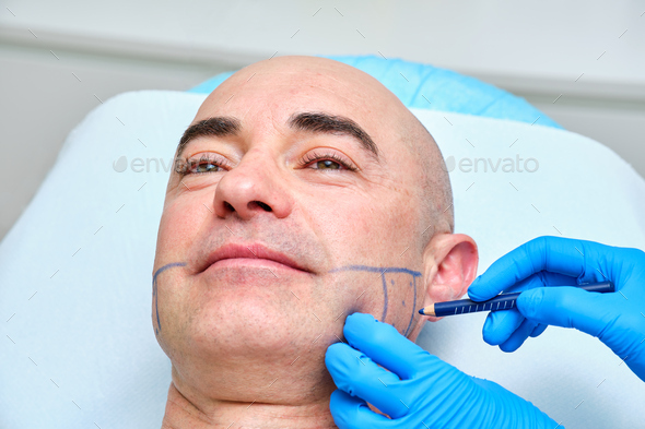 marking the face of a man with a dermographic pencil for treatment with ...