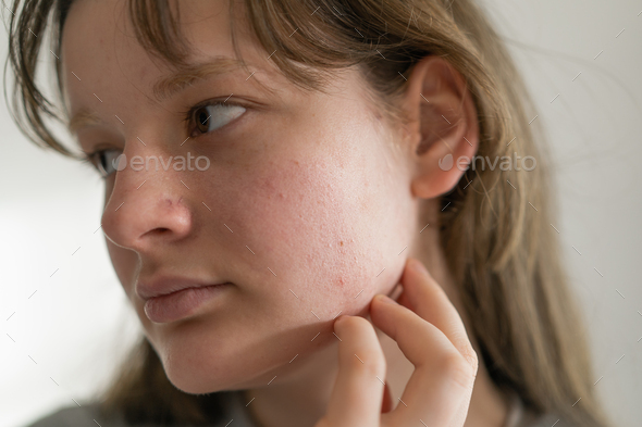 Problem skin face. A teenage girl with a troubled face. Stock Photo by ...