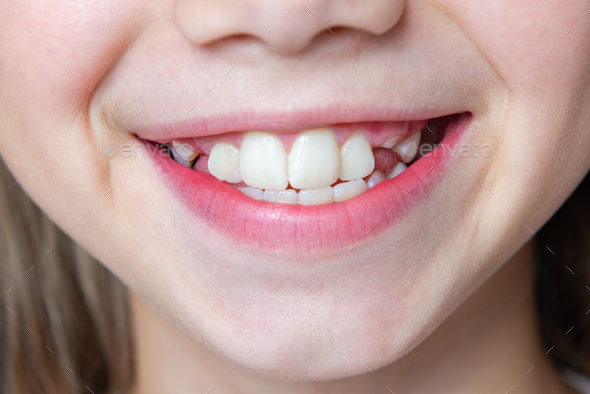 Child smiles and shows jagged teeth. Dental medicine and healthcare ...