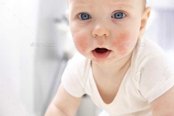 Baby face with allergic rash on cheeks. Stock Photo by ta_bu | PhotoDune