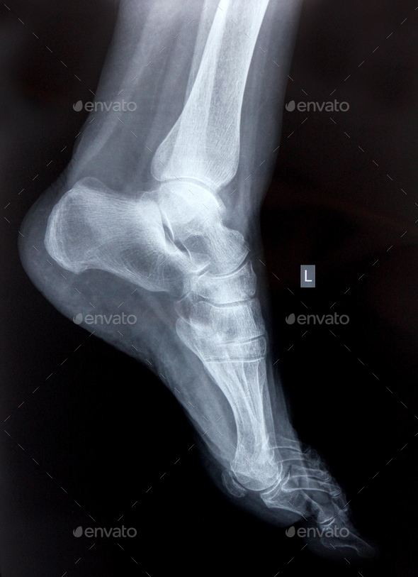 X ray of a foot and ankle Stock Photo by iheartcreative | PhotoDune