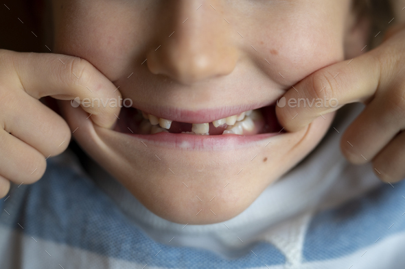 Closeup view of a toddler boy showing his missing milk teeth Stock ...