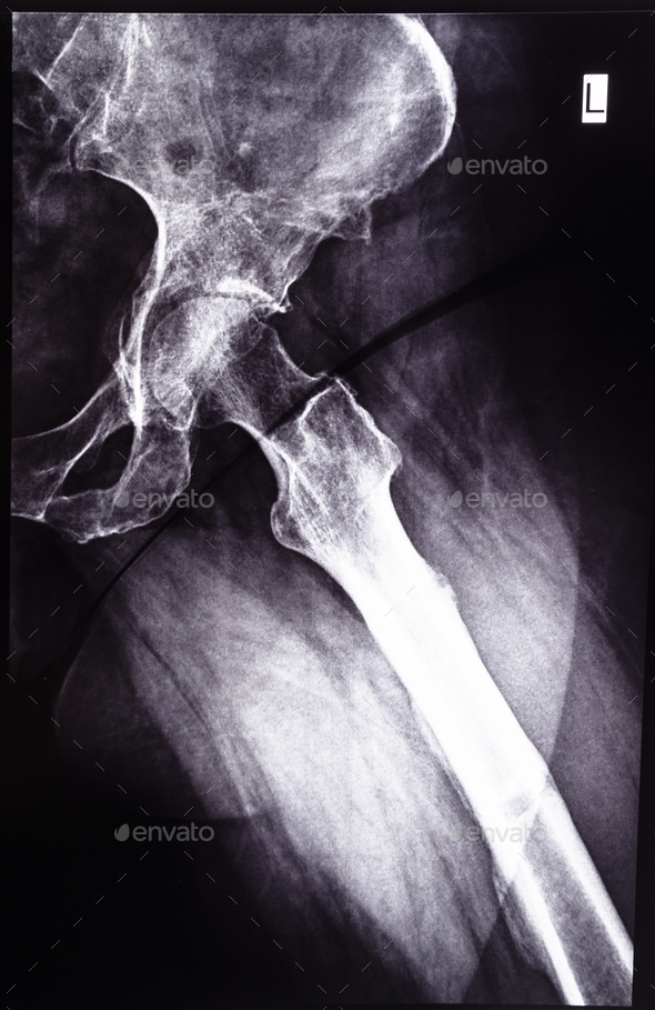 negative x-ray side view of acetabular cavity Stock Photo by vvoennyy