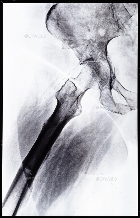 x-ray side view of junction of tibia and pelvis Stock Photo by vvoennyy