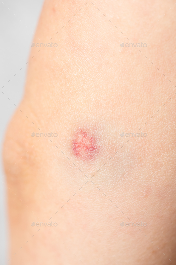 big bruise on the girl's skin close up. Skin hematoma. Purple wound ...