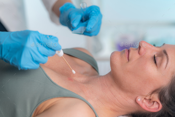 Dermatologist taking sample from patients skin and examining potential ...