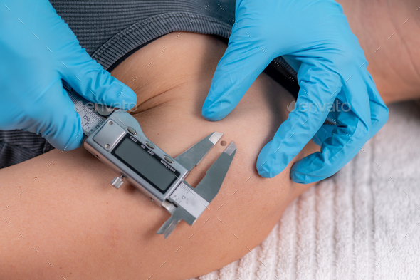 Dermatologist Measures Mole Safeguarding Skin Health Stock Photo by ...