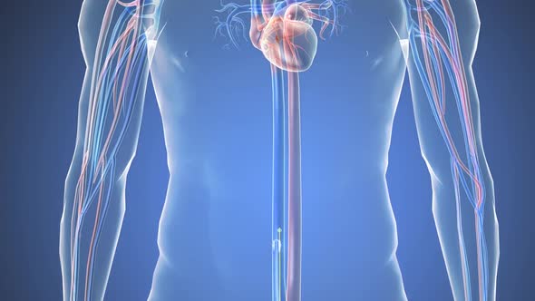 . Opening the occluded artery by inserting a stent, Motion Graphics