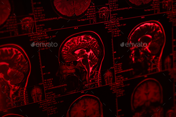 MRI or magnetic resonance imaging of the head and brain in red light ...