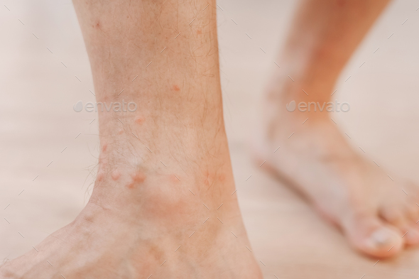 Close up allergic rash dermatitis eczema on man foot. Leg with red rash ...