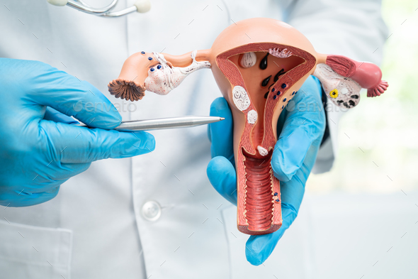Uterus, doctor holding anatomy model for study diagnosis and treatment ...